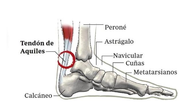 ¿Tendón de Aquiles o talón de Aquiles? | El Diario Vasco